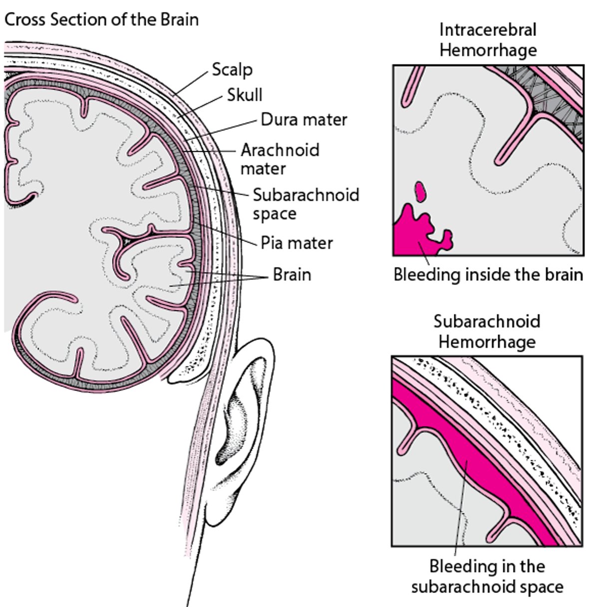 Overview Of Hemorrhagic Stroke Brain Spinal Cord And Nerve