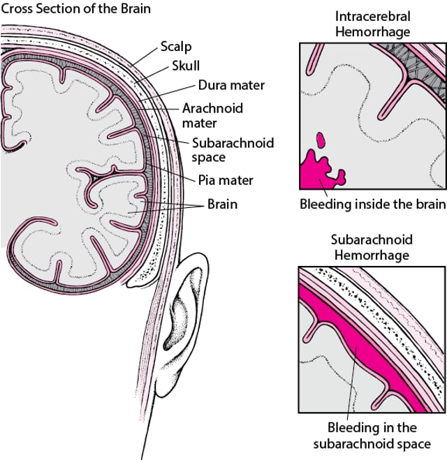 Subarachnoidalblutung (SAB) - Störungen der Hirn-, Rückenmarks- und ...