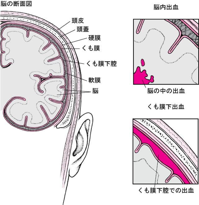 Image破裂はれつと破綻はたん:出血性しゅっけつせい脳卒中のうそっちゅうの原因げんいん Msdマニュアル家庭版