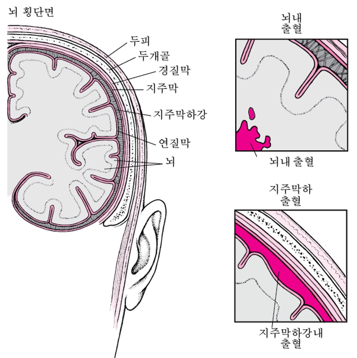 출혈성 뇌졸중 개요 뇌 척수 신경 장애 Msd 매뉴얼 일반인용