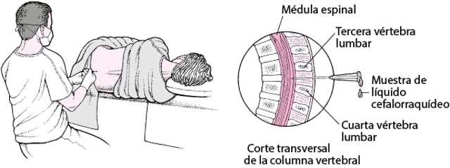Cefalea por hipotensión - Enfermedades cerebrales, medulares y ...