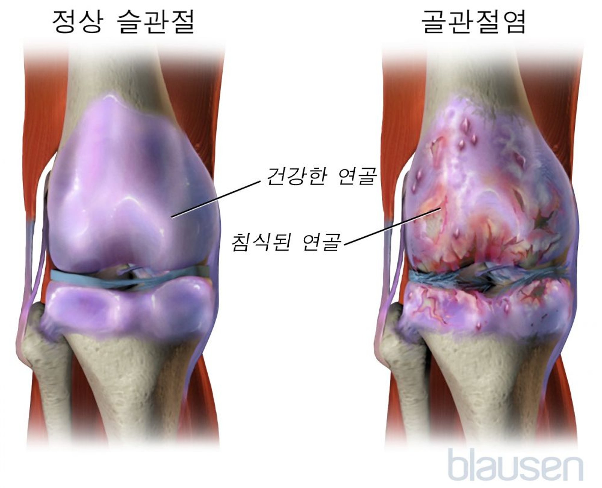 골관절염oa 골관절염oa Msd 매뉴얼 일반인용