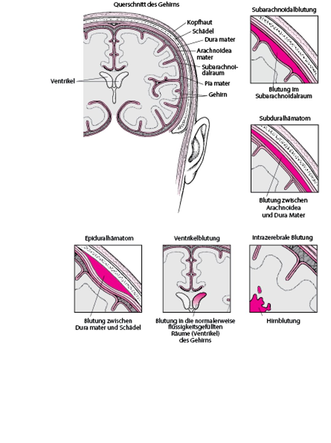 Image:Blutung um das Gehirn herum-MSD Manual Ausgabe für Patienten