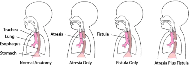 Esophageal Atresia and Tracheoesophageal Fistula - Children's Health ...