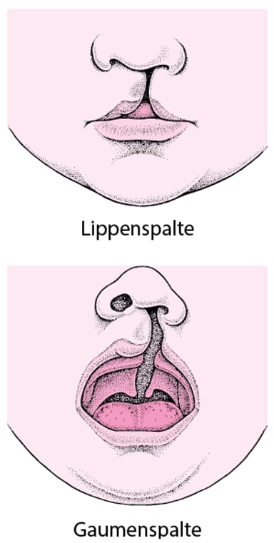 Lippen- und Gaumenspalte - Gesundheitsprobleme von Kindern - MSD Manual ...