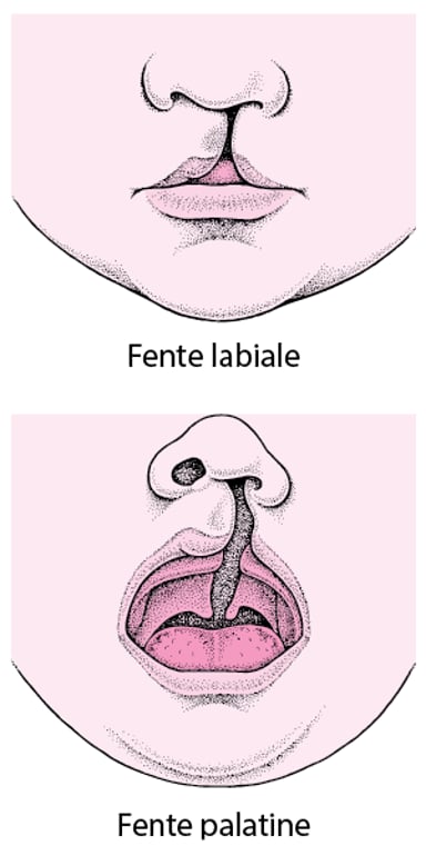 Fente labiale et fente palatine - Problèmes de santé infantiles ...
