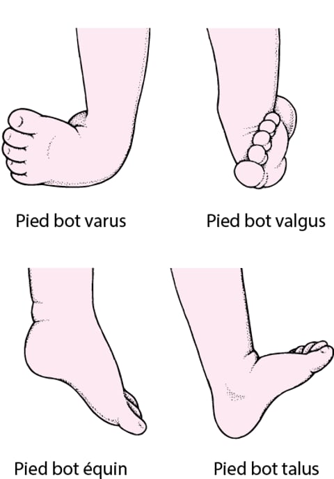 Pied bot et autres malformations du pied - Problèmes de santé ...