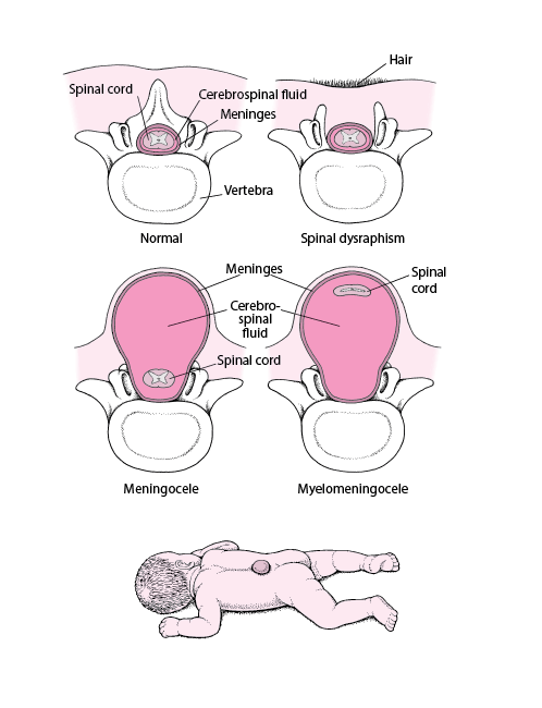 Neural Tube Defects and Spina Bifida - Children's Health - Merck Manual ...