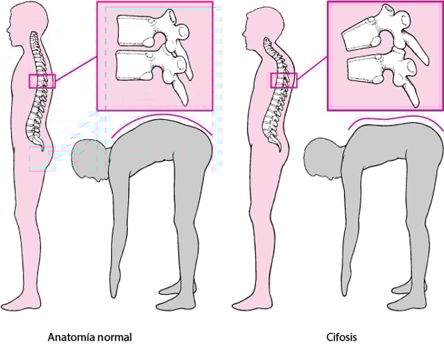Cifosis - Cifosis - Manual MSD versión para público general