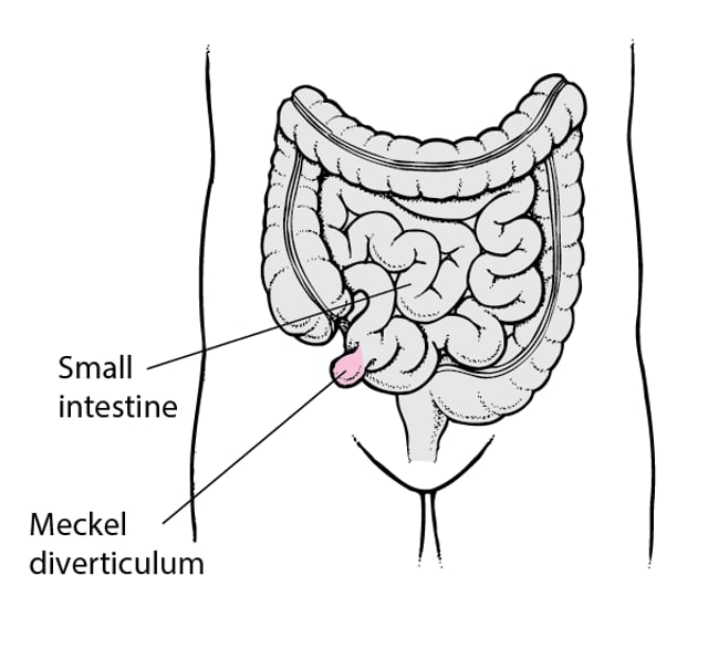 Meckel Diverticulum - Meckel Diverticulum - MSD Manual Consumer Version