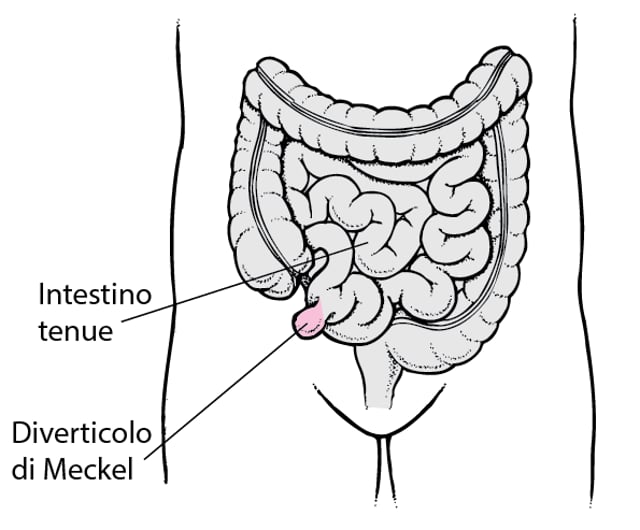 Diverticolo di Meckel - Diverticolo di Meckel - Manuale MSD, versione ...