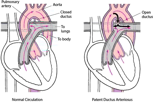 Quick Facts:Patent Ductus Arteriosus - Merck Manual Consumer Version