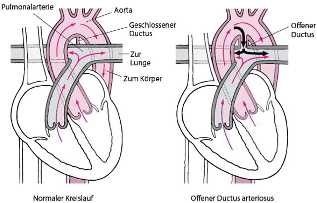 Persistierender Ductus arteriosus - Persistierender Ductus arteriosus ...