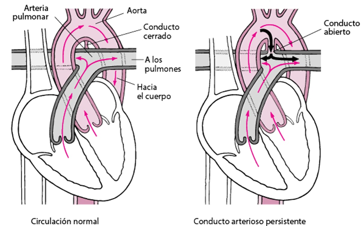 Image:Conducto arterioso persistente: defecto de cierre-Manual MSD ...