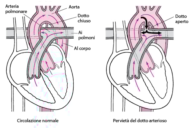 I fatti in Breve:Dotto arterioso pervio - Manuale MSD, versione per i ...