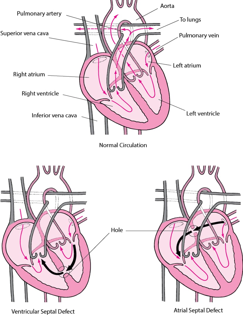 Quick Facts:Atrial and Ventricular Septal Defects - MSD Manual Consumer ...