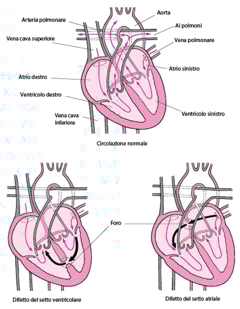 Difetti del setto interatriale e interventricolare - Problemi di salute ...