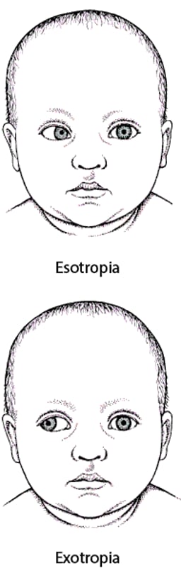 Image:Strabismus: A Misaligned Eye-MSD Manual Consumer Version