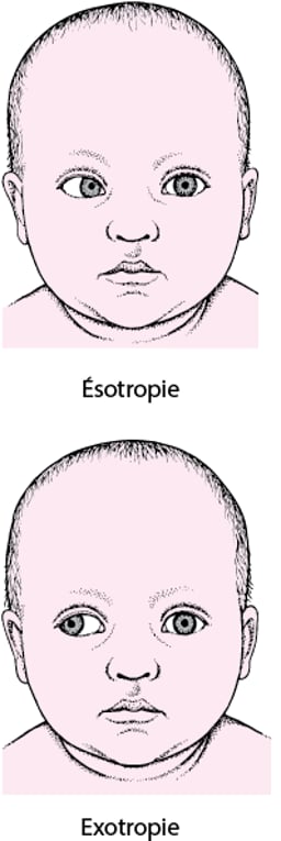 Strabisme - Problèmes de santé infantiles - Manuels Merck pour le grand ...