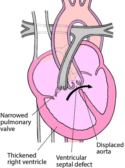 Tetralogy of Fallot - Children's Health Issues - Merck Manual Consumer ...