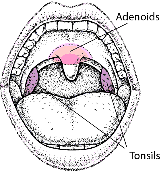 Enlarged Tonsils and Adenoids in Children - Children's Health Issues - Merck Manual Consumer Version