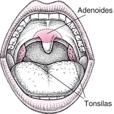 Distúrbios das adenoides - Distúrbios das adenoides - Manual MSD Versão ...