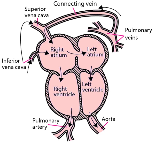 Image:Total Anomalous Pulmonary Venous Return-MSD Manual Consumer Version