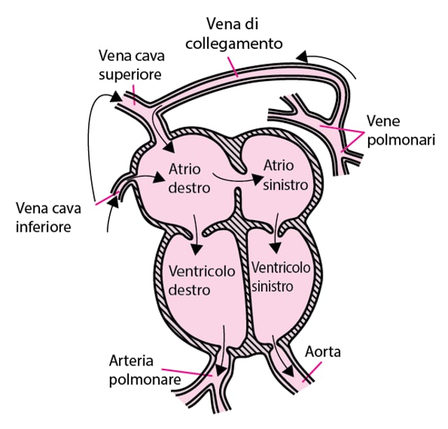 Image:Ritorno venoso polmonare anomalo totale-Manuale MSD, versione per ...