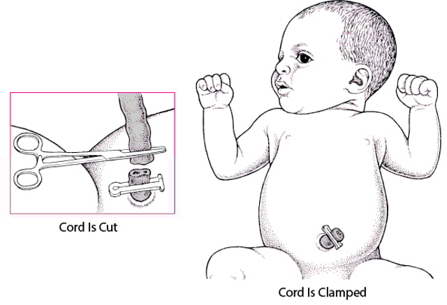 Imagecutting The Umbilical Cord Msd Manual Consumer Version