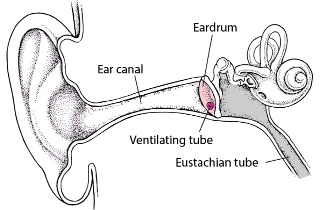 Otitis Media (Serous) - Otitis Media (Serous) - MSD Manual Consumer Version