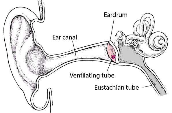 Image:Myringotomy: Treating Secretory Otitis Media-Merck Manual ...