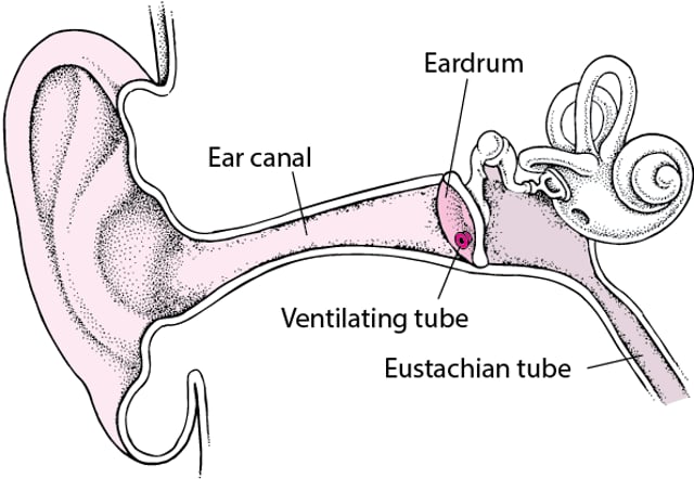 Otite moyenne aiguë - Troubles du nez, de la gorge et de l’oreille ...