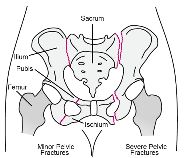 Image:Pelvic Fractures-Merck Manual Consumer Version