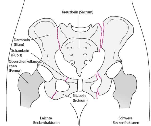 Kurzinformationen:Gebrochenes Becken - MSD Manual Ausgabe für Patienten