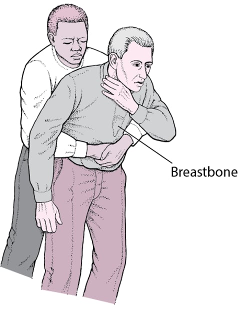 Image:Performing Abdominal Thrusts (Heimlich Maneuver)-MSD Manual ...