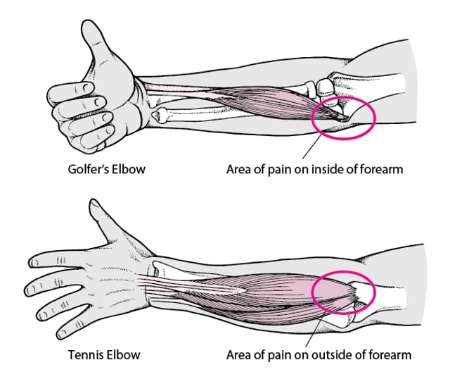 Elbow Injuries - Injuries and Poisoning - Merck Manual Consumer Version