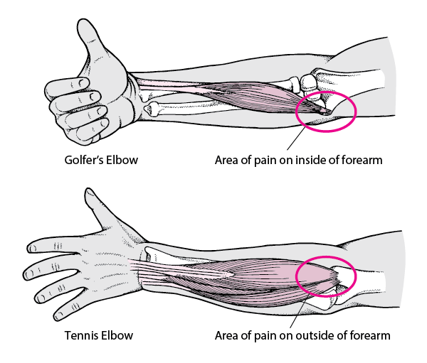 Elbow Injuries - Injuries and Poisoning - MSD Manual Consumer Version