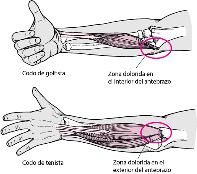 Lesiones del codo - Lesiones del codo - Manual MSD versión para público ...