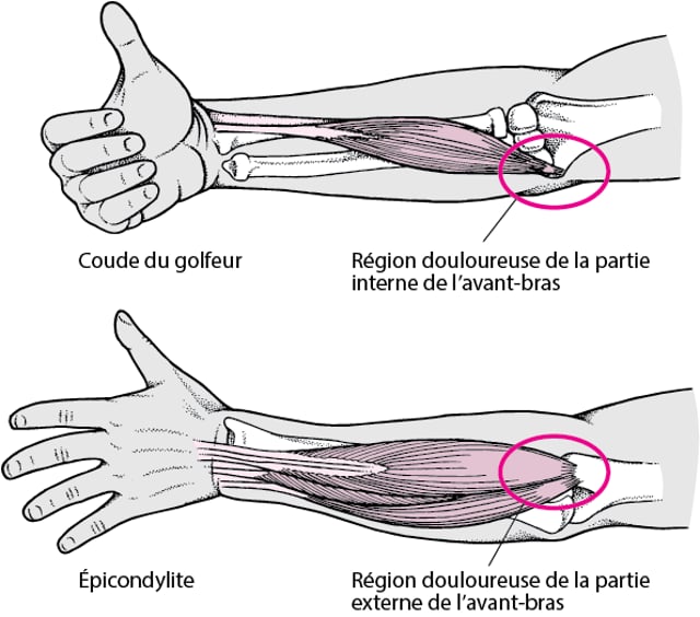 Lésions des coudes - Lésions et intoxications - Manuels MSD pour le ...