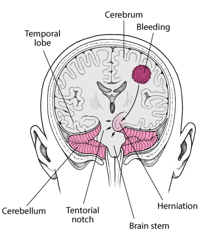 Image:Herniation: The Brain Under Pressure-MSD Manual Consumer Version