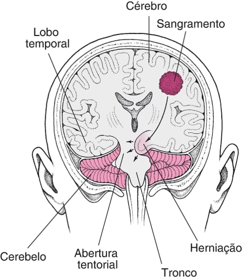 Herniação cerebral - Distúrbios cerebrais, da medula espinal e dos ...