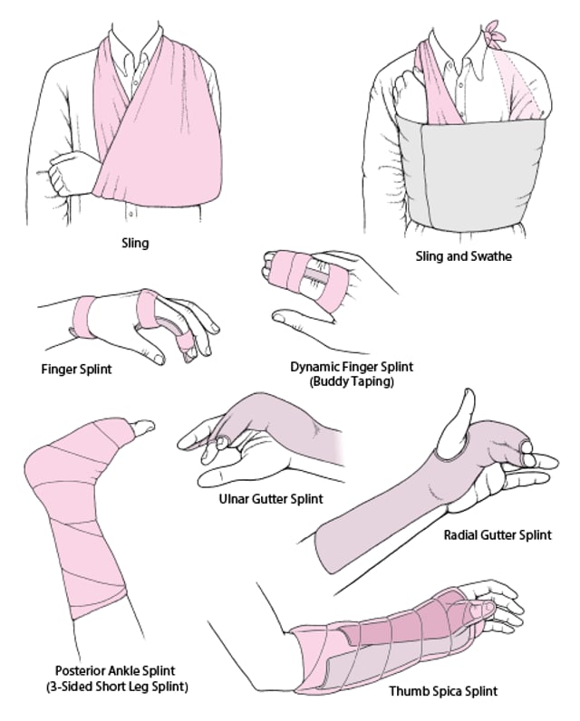 Overview of Dislocations - Injuries and Poisoning - MSD Manual Consumer ...