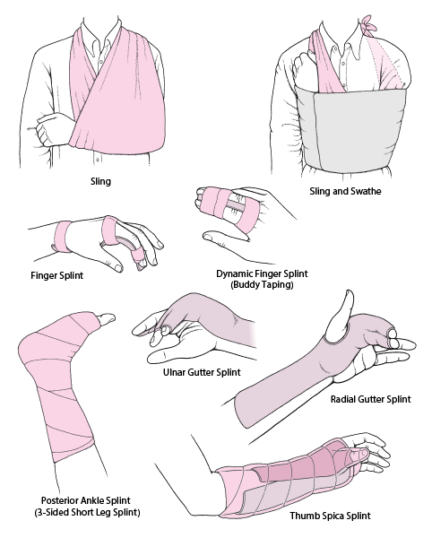 Overview of Dislocations - Injuries and Poisoning - MSD Manual Consumer ...