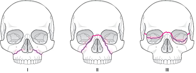 Fractures of the Jaw and Midface - Fractures of the Jaw and Midface ...