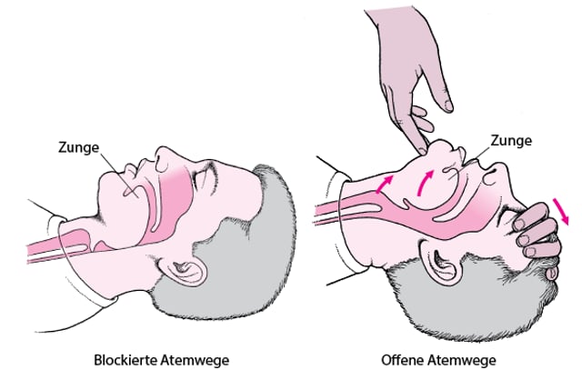 Image:Freimachen der Atemwege bei einem Erwachsenen oder Kind-MSD ...