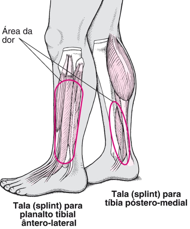Periostite tibial - Lesões e envenenamentos - Manual MSD Versão Saúde ...