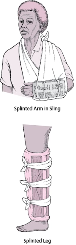 Image:Commonly Used Splints-MSD Manual Consumer Version