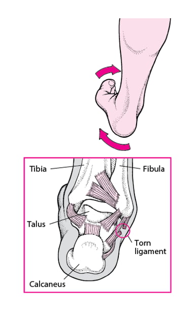 Ankle Sprains - Injuries and Poisoning - MSD Manual Consumer Version
