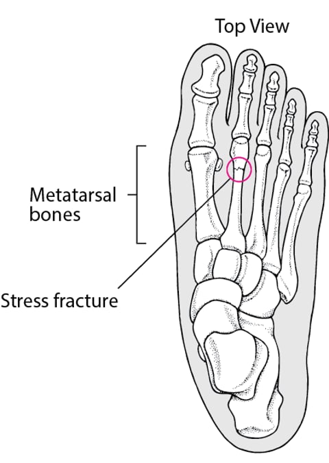 Stress Fractures of the Foot - Injuries and Poisoning - MSD Manual ...