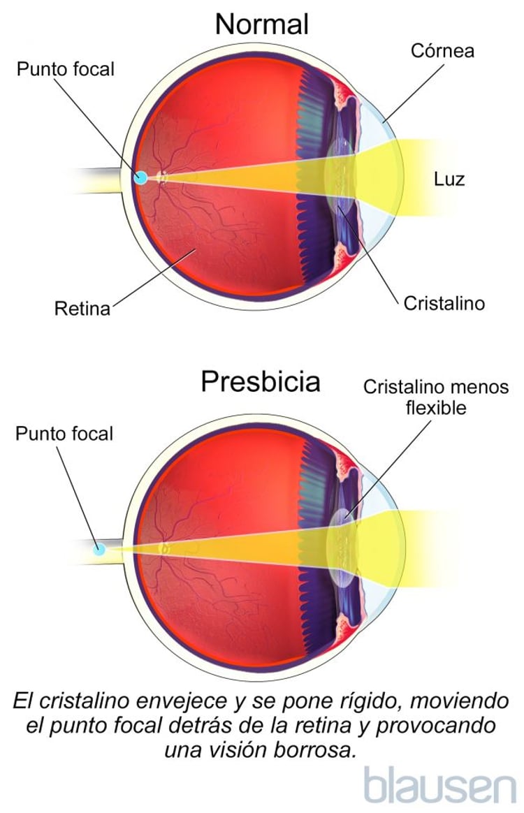 Introducción a los trastornos de refracción - Trastornos oftálmicos ...